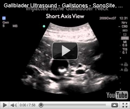 BILIARY COLIC and ACUTE CHOLECYSTITIS - RME